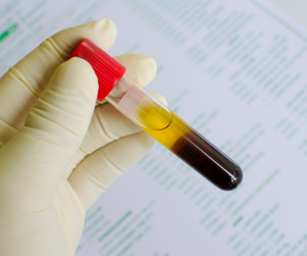 Blood Clotting Disorders: What Coagulation Tests Can Tell You - PATH 24 ...